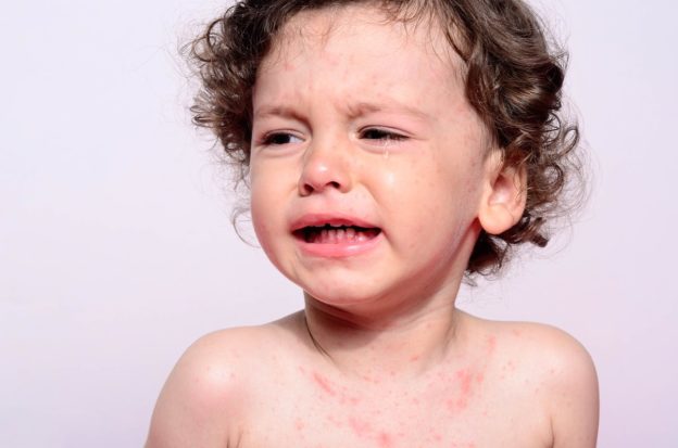 Heat Rash in Children: Causes, Symptoms & Care