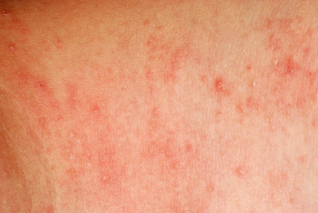 Heat Rash in Children: Causes, Symptoms & Care