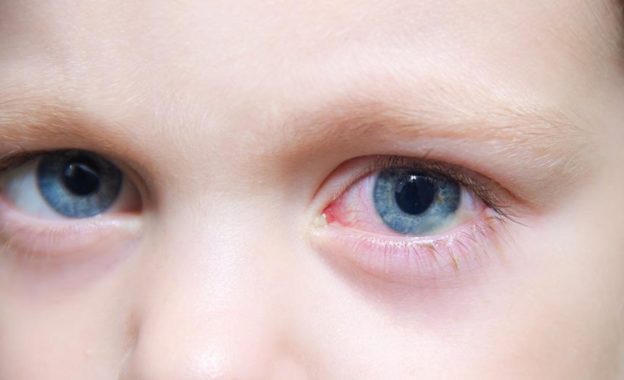 What You Should Know About Pink Eye - Frisco Pediatrician Entirely Kids ...